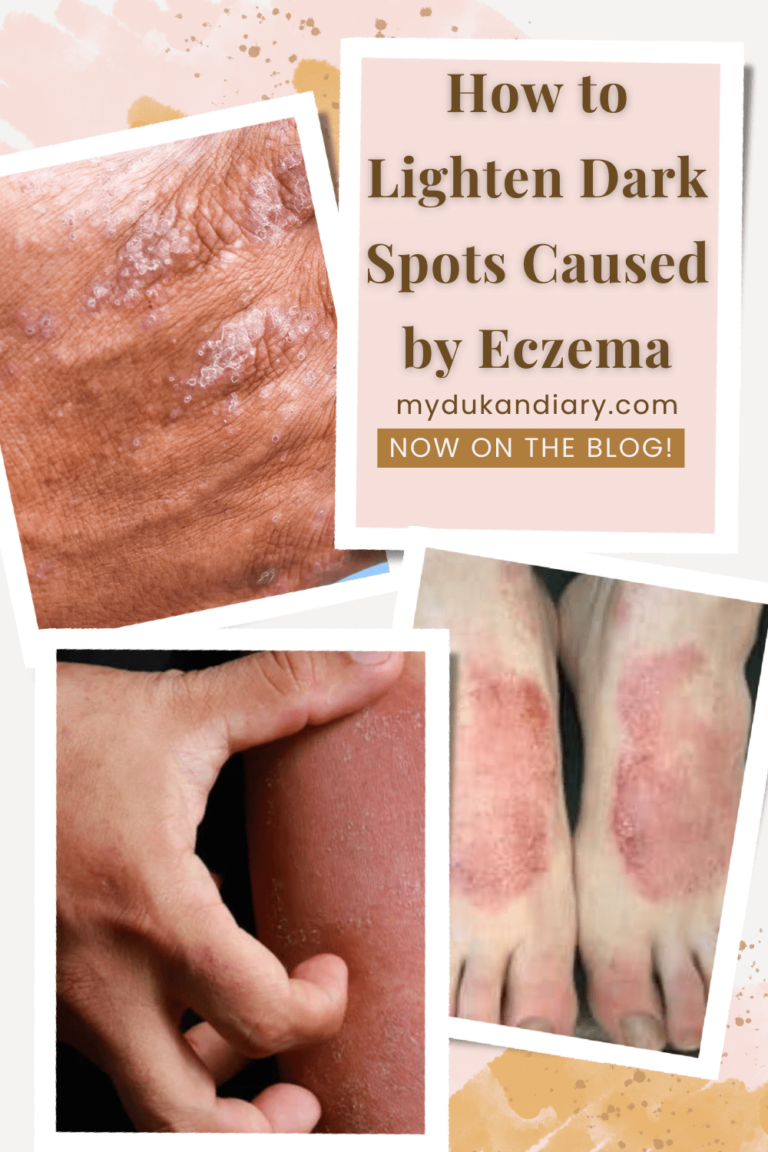 How to Lighten Dark Spots Caused by Eczema - My Dukan Diary